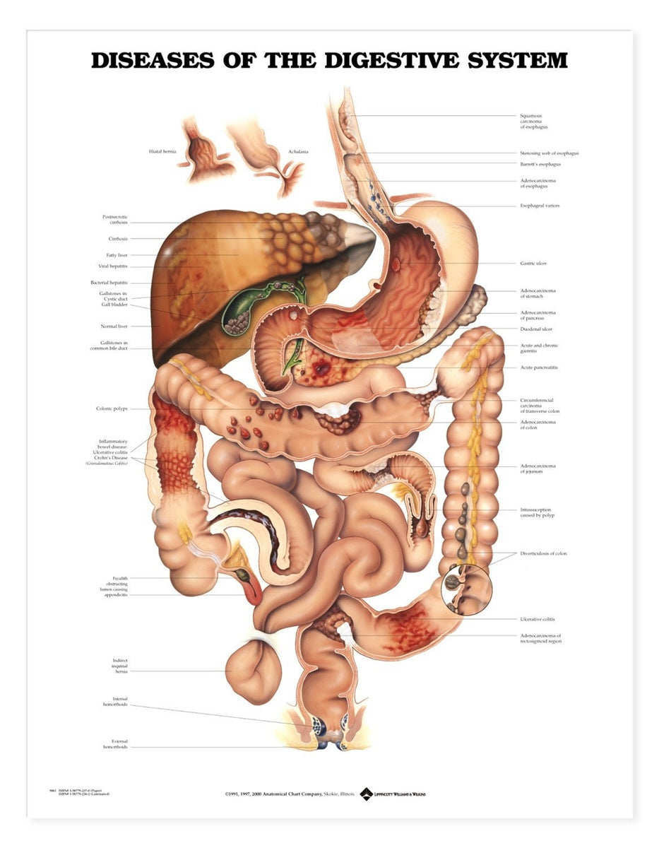 Diseases of the Digestive System Wall Chart - Laminated, 20"W x 26"L ...